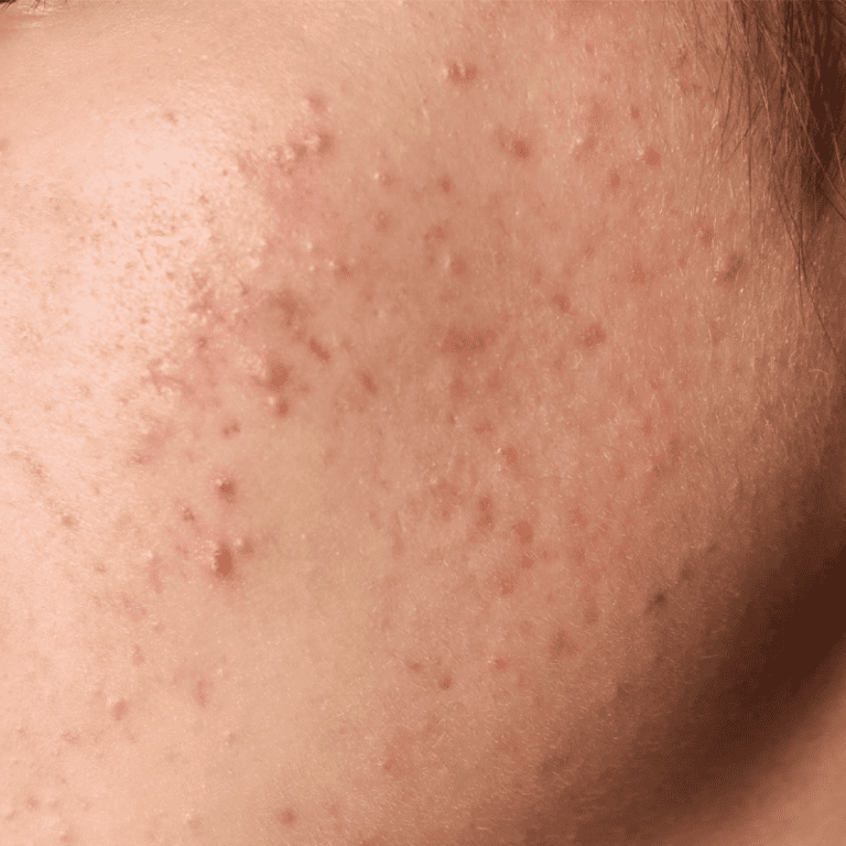 Acne & Acne Scars - Verve Clinic